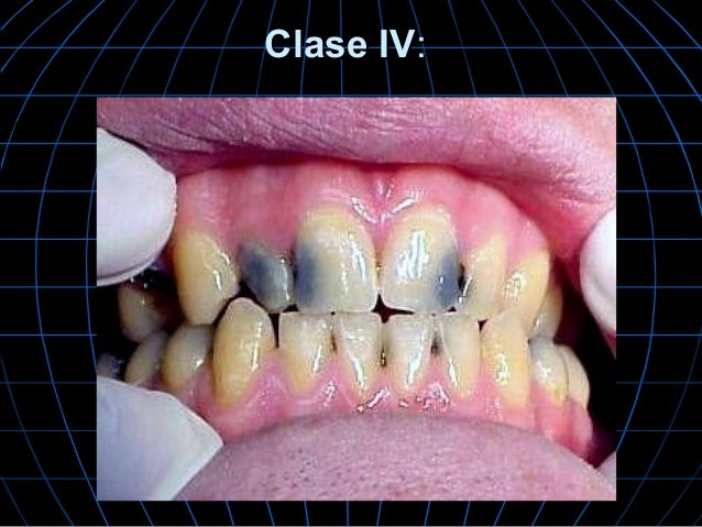 Caries dental