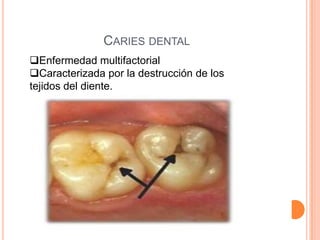 Caries dental | PPTX