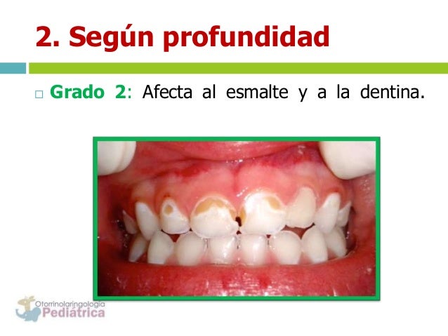 Caries dental