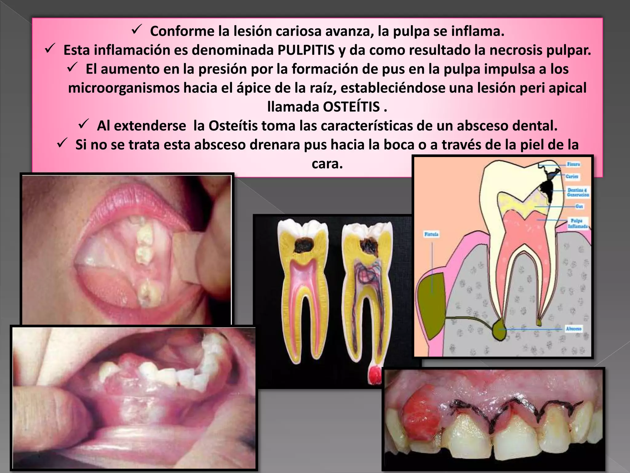 CARIES DENTAL | PPTX