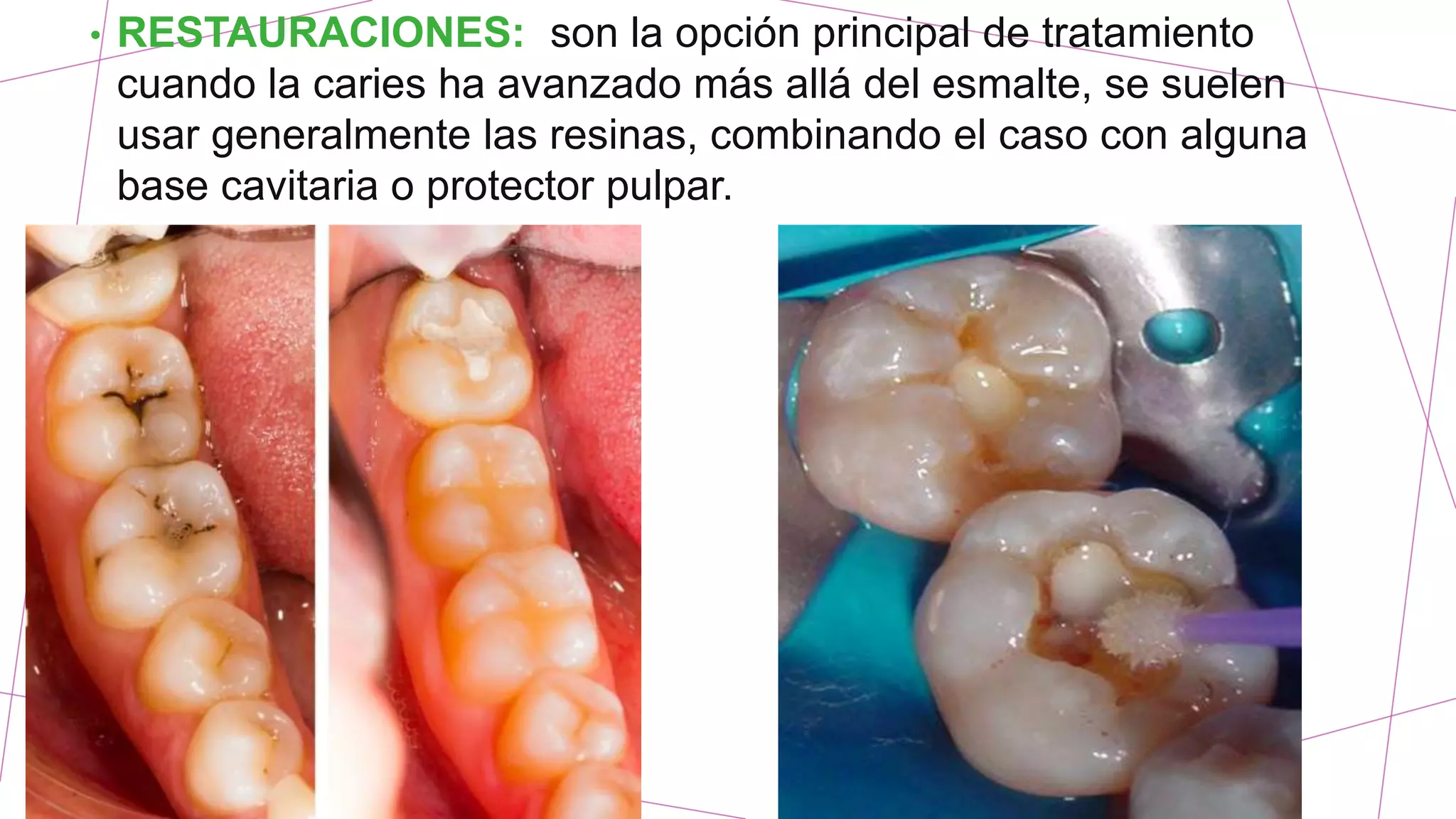 CARIES- TIPOS DE CARIES- TRATAMIENTOS | PPTX