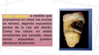 CARIES- TIPOS DE CARIES- TRATAMIENTOS | PPTX