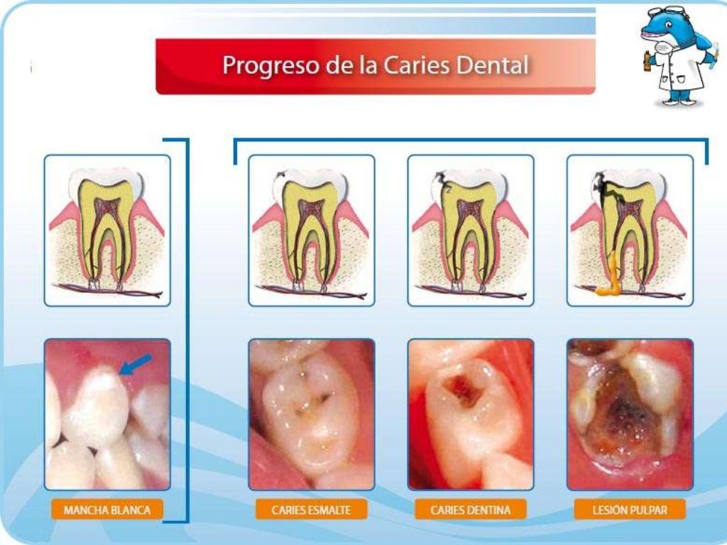 Caries dentales patologia