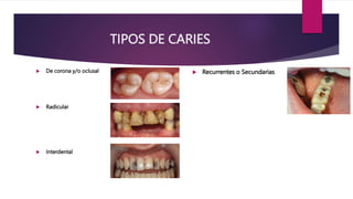 CARIES DENTAL Y GINGIVITIS CRONICA .pptx