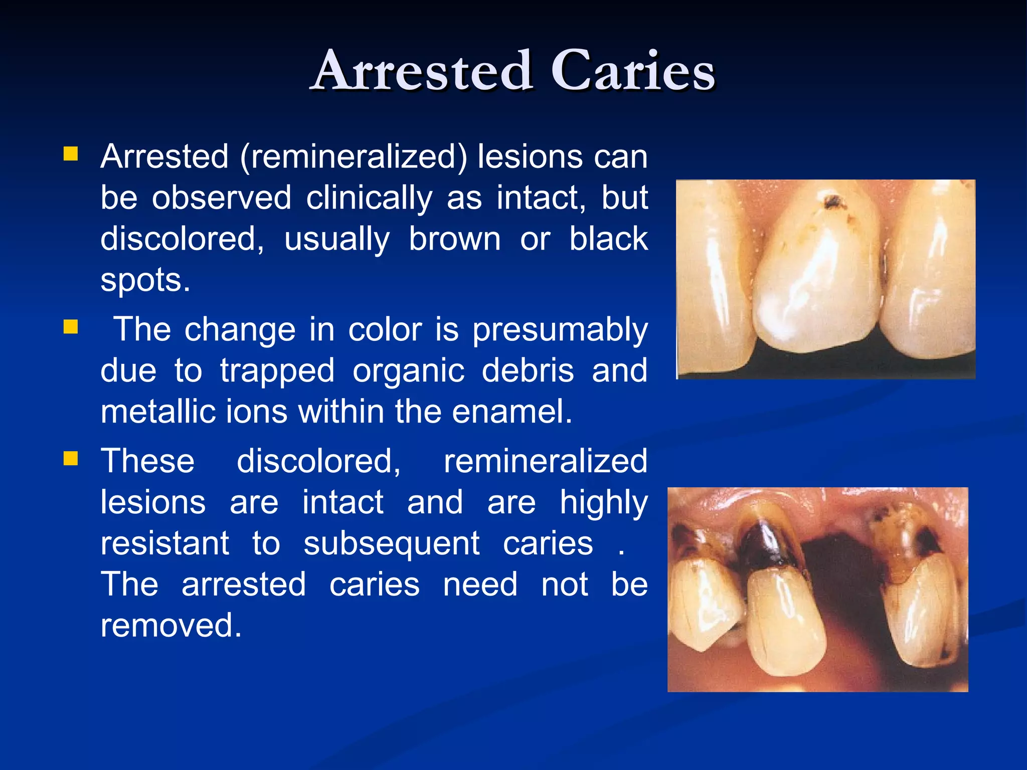 Caries diagnosis | PPT