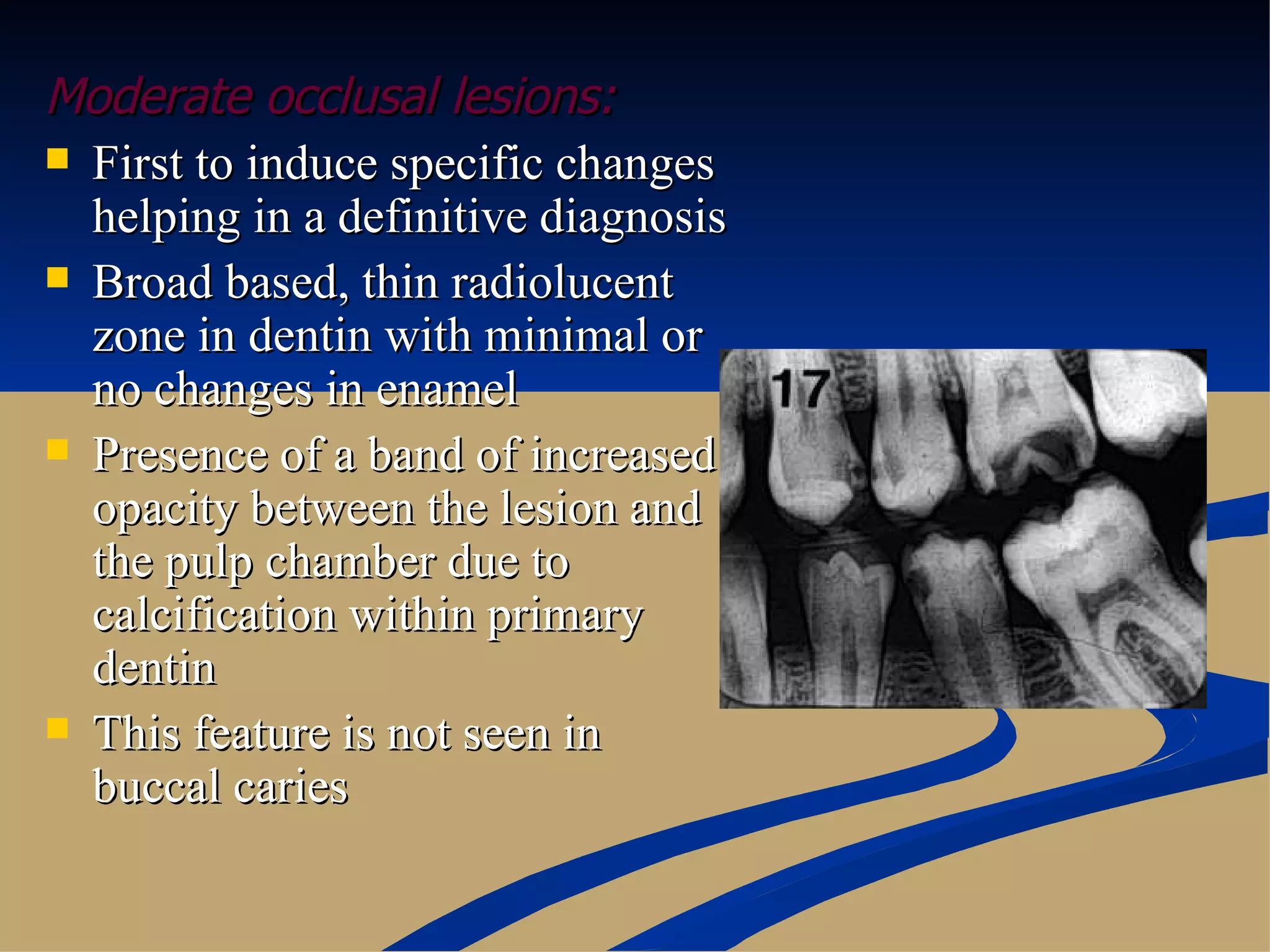 Caries diagnosis | PPT