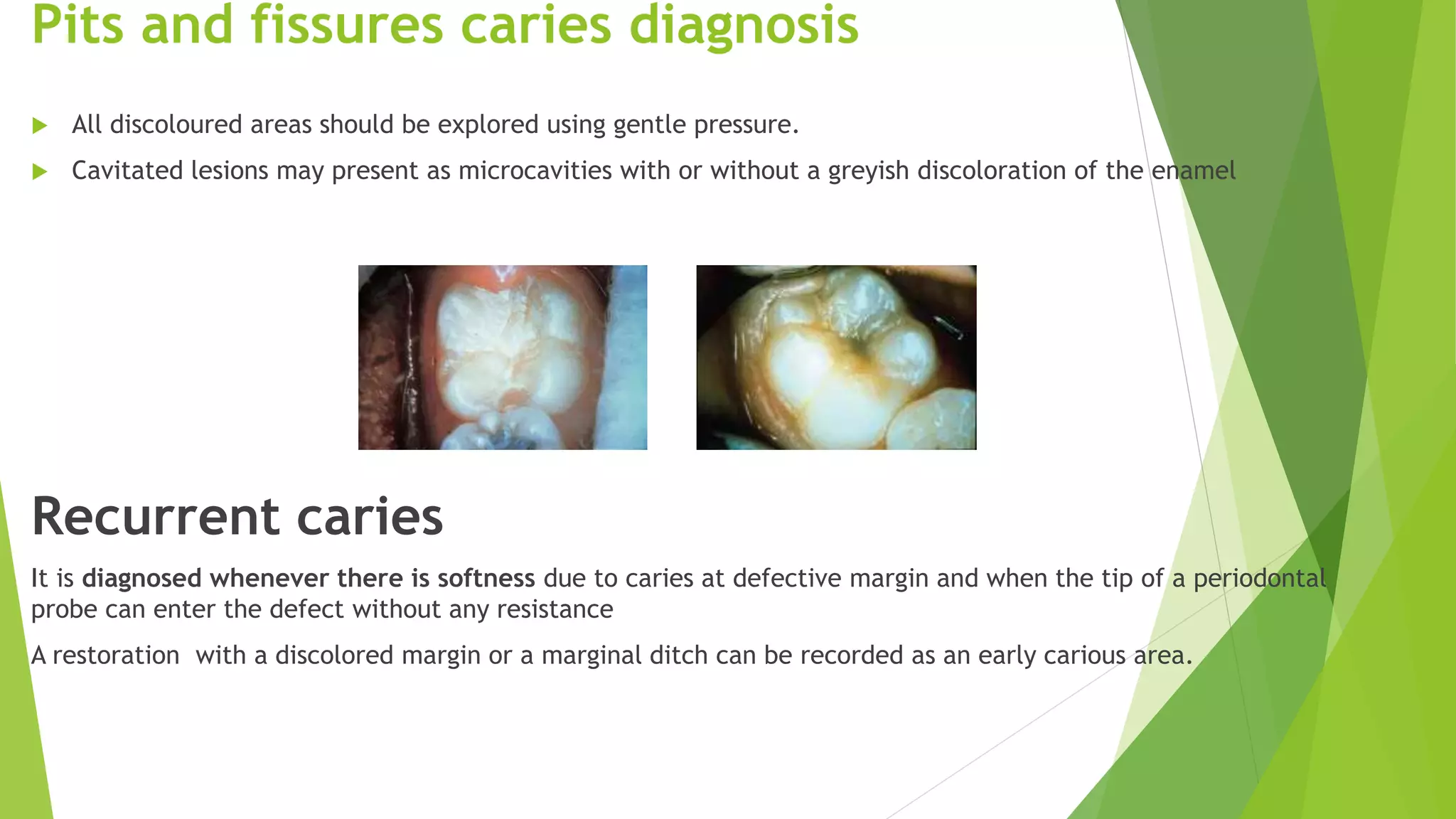 Caries diagnosis | PPTX