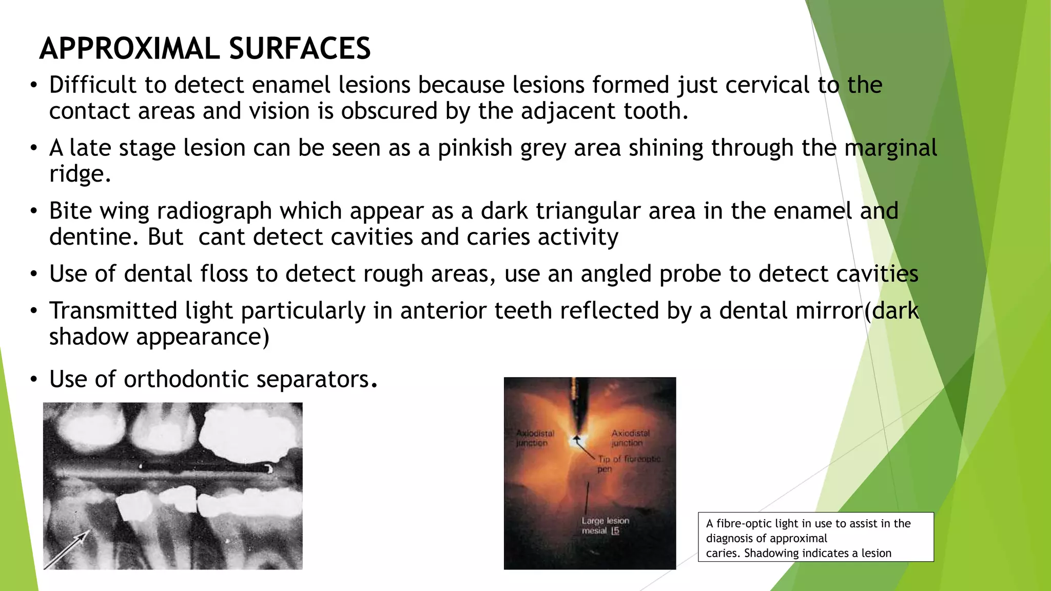 Caries diagnosis | PPTX