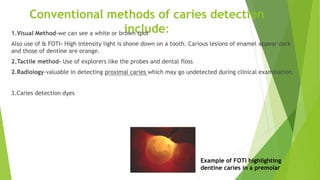 Caries diagnosis | PPTX