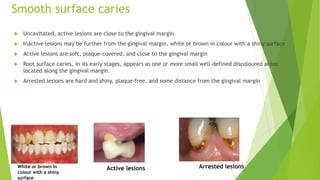 Caries diagnosis | PPTX