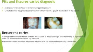 Caries diagnosis | PPTX