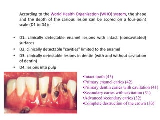 Caries diagnosis | PPT