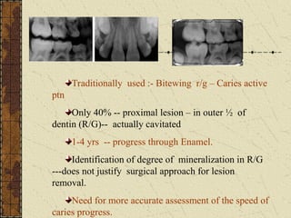 CARIES DIAGNOSIS-- Dr Thejokrishna P.ppt