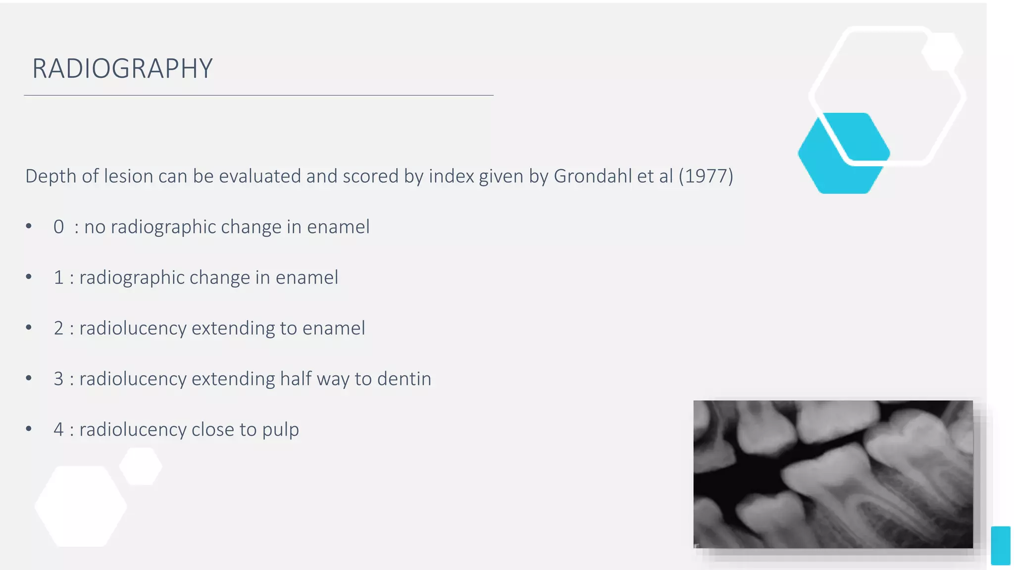 Caries diagnosis : NEW TRENDS | PPTX