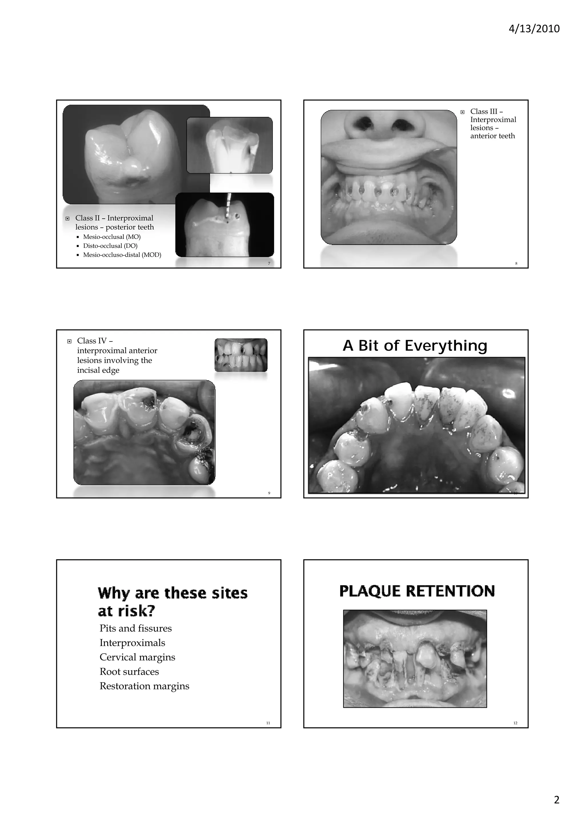 Caries diagnosis handout | PDF