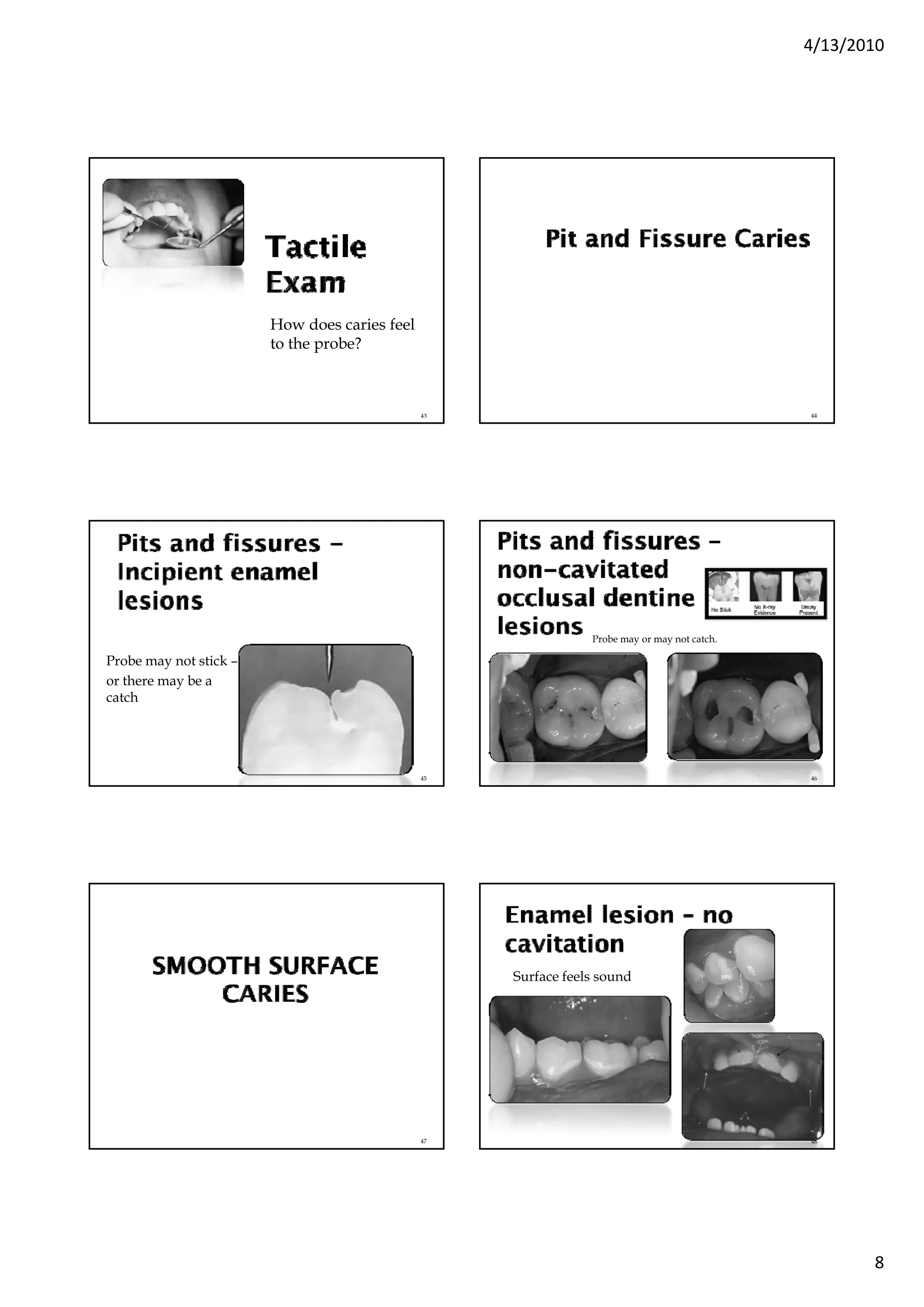 Caries diagnosis handout | PDF