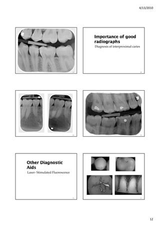 Caries diagnosis handout | PDF