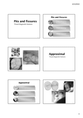 Caries diagnosis handout | PDF