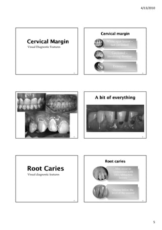 Caries diagnosis handout | PDF