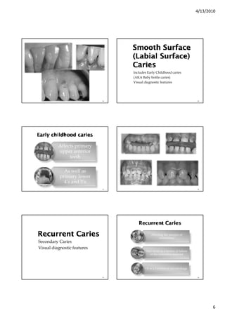 Caries diagnosis handout | PDF