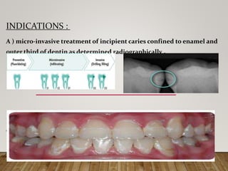 Caries infiltration | PPTX