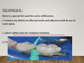 Caries infiltration | PPTX