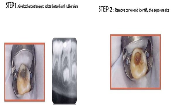 Caries management strategies in primary molars | PPTX | Dental Health ...