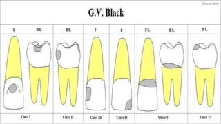 Caries management strategies in primary molars | PPTX