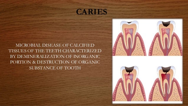 Caries management strategies in primary molars