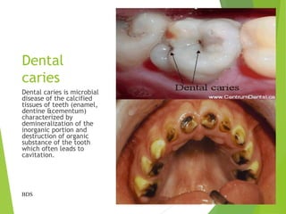 Caries microbiology | PPT | Dental Health | Diseases and Conditions