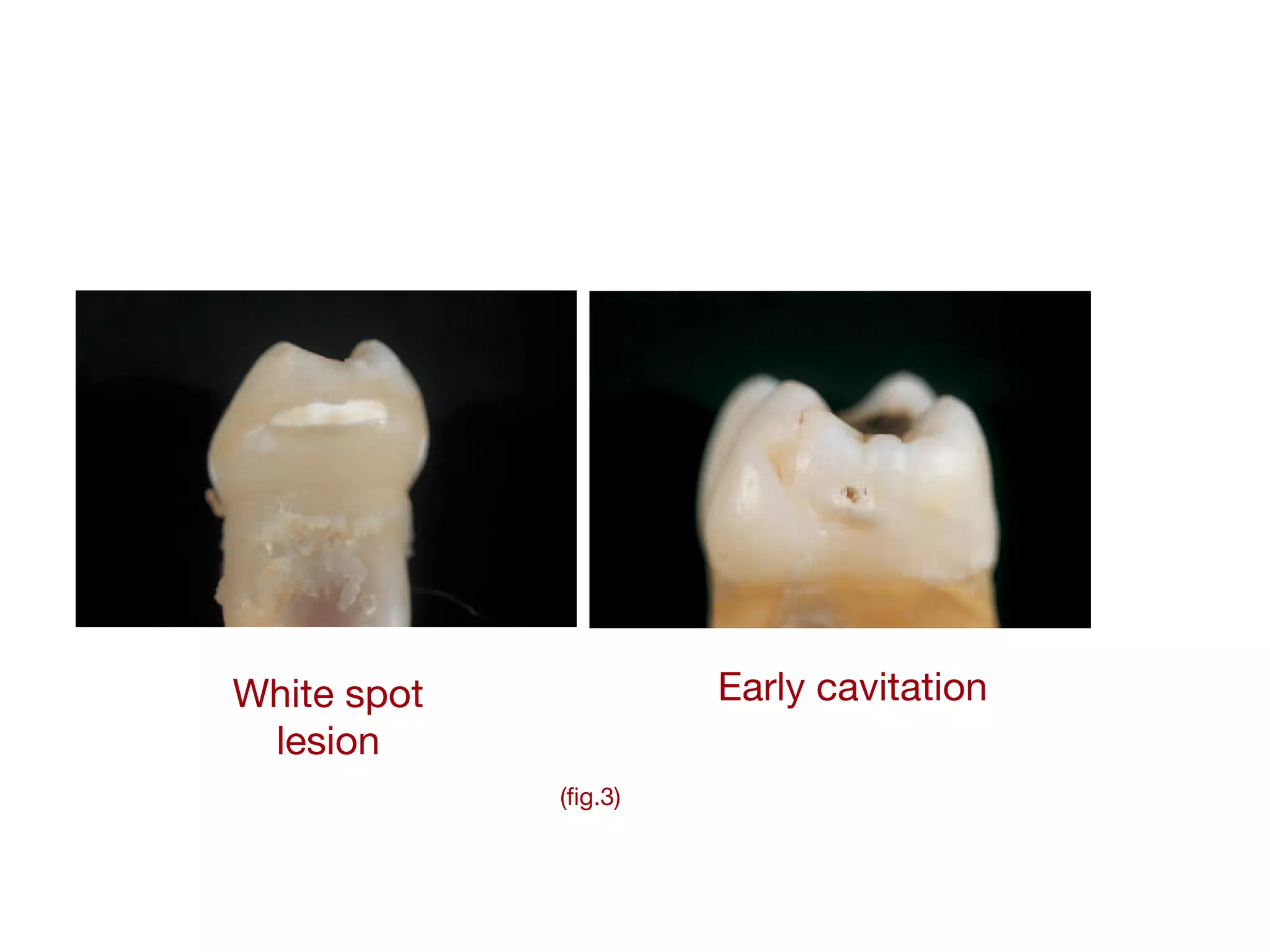 Dental Caries (bacterial tooth loss) | PDF