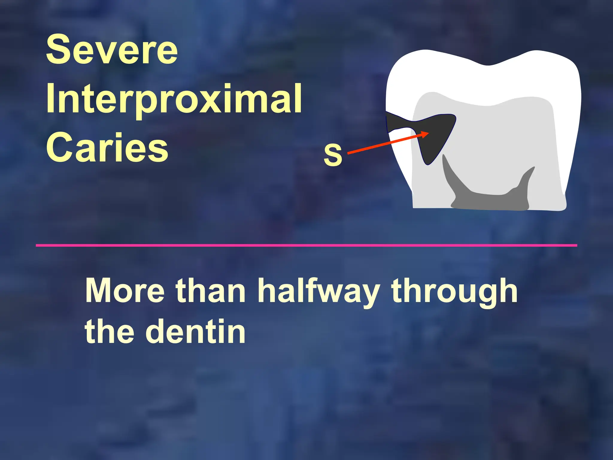 Caries and Periodontal Localization.ppt