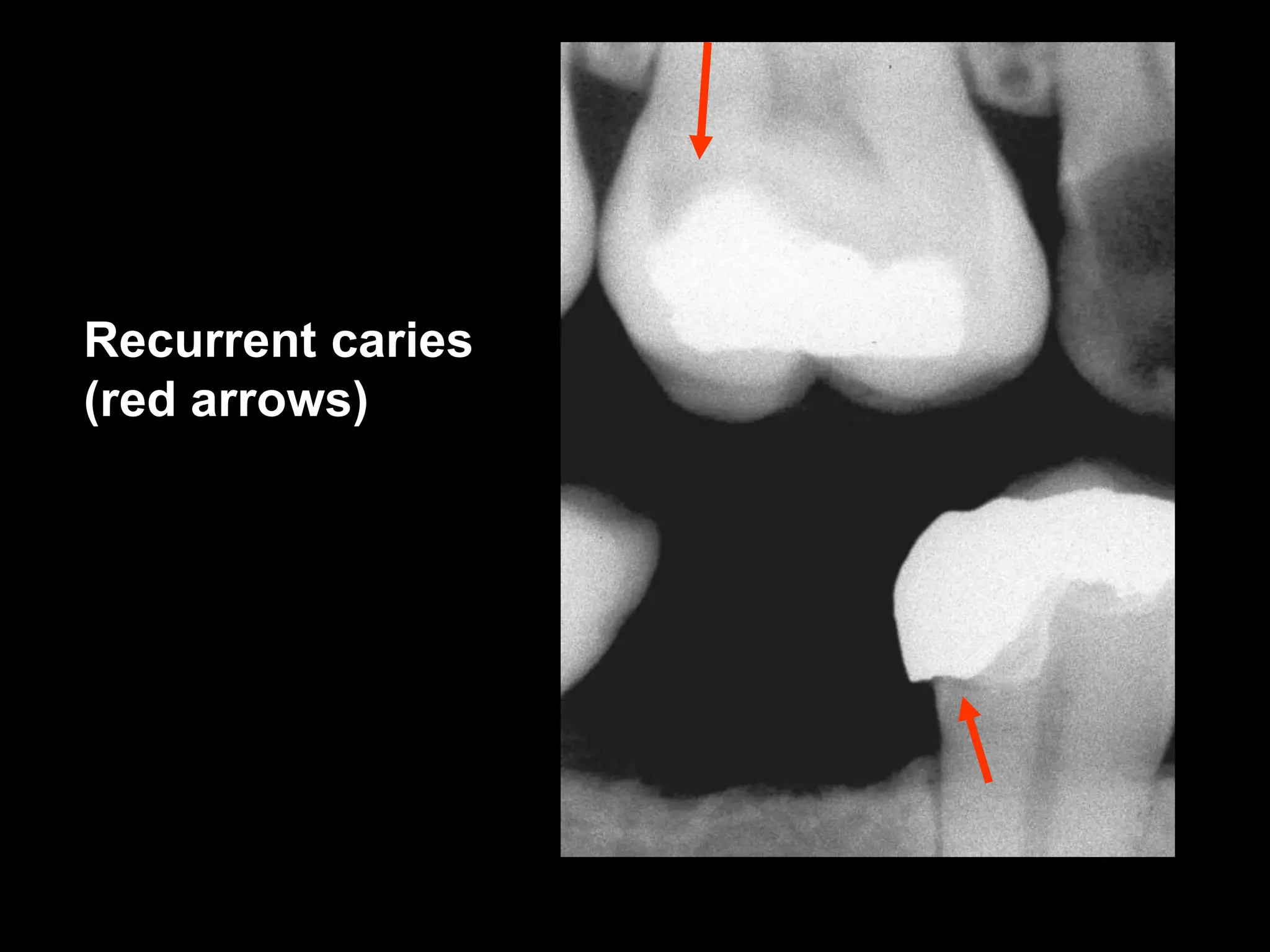 Caries and Periodontal Localization.ppt