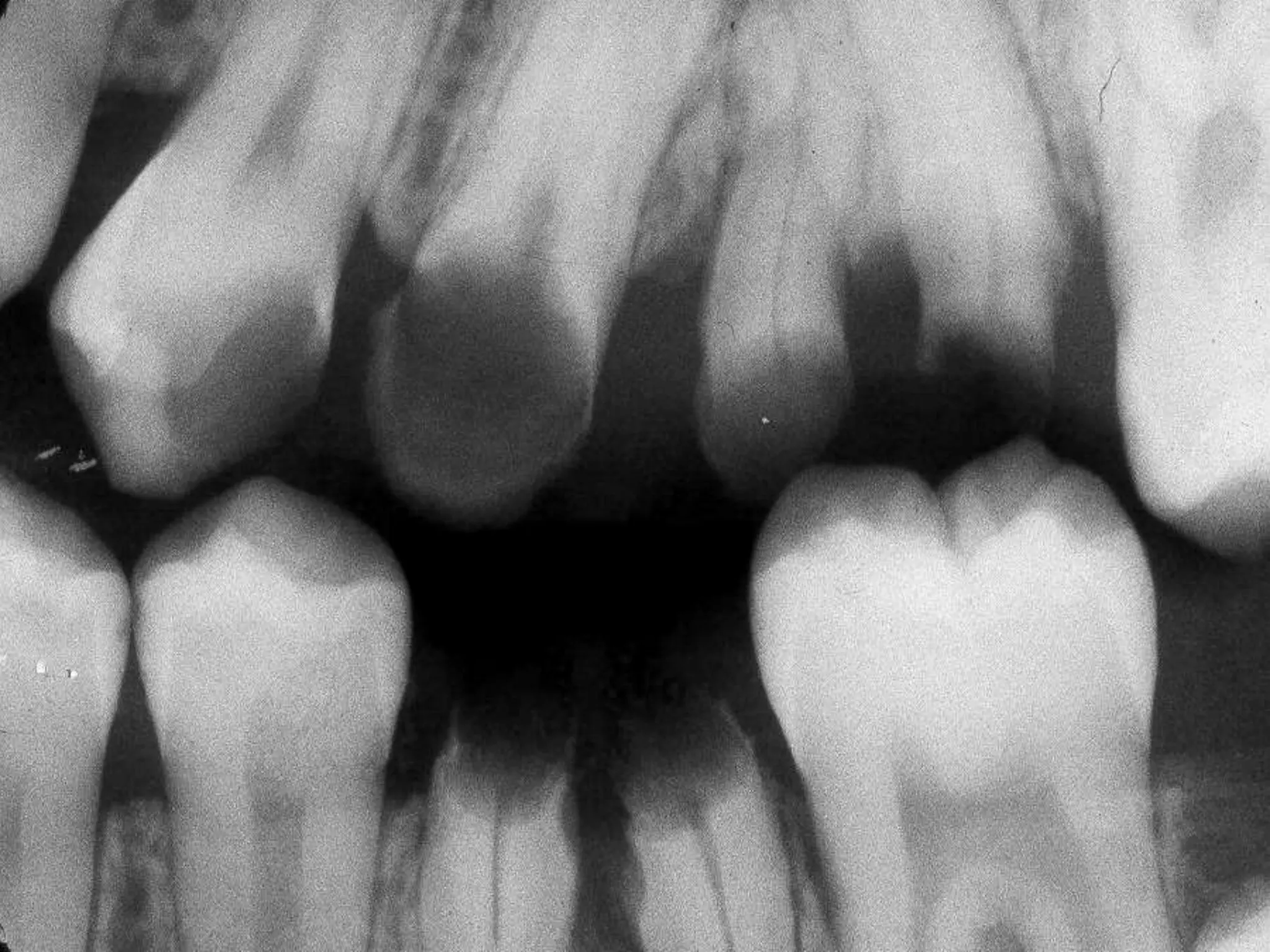 Caries and Periodontal Localization.ppt