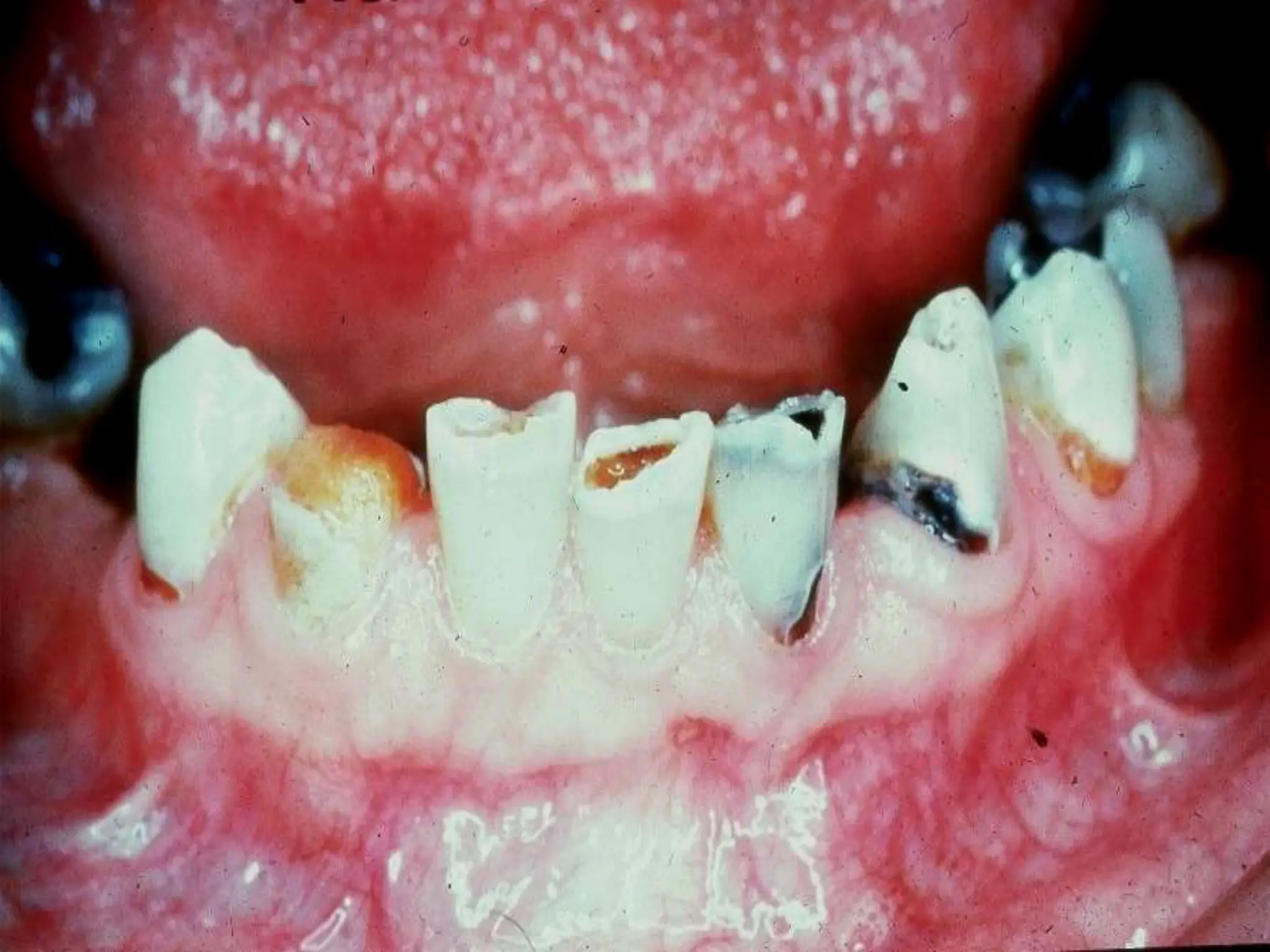 Caries and Periodontal Localization.ppt