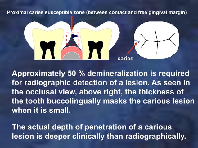 Caries and Periodontal Localization.ppt