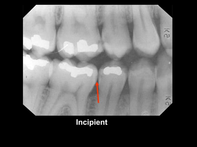 Caries and Periodontal Localization.ppt