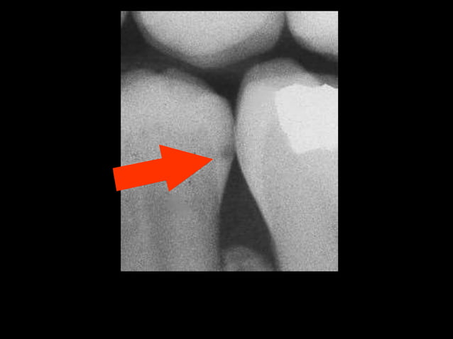 Caries and Periodontal Localization.ppt