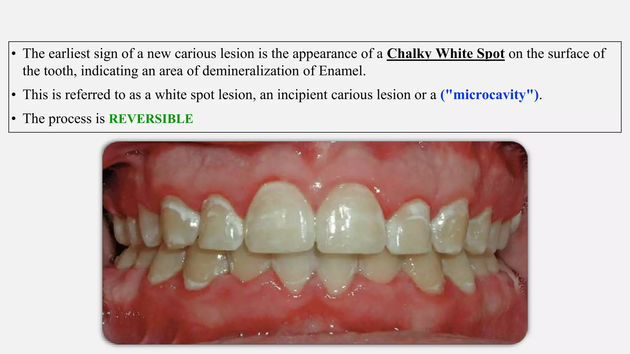 Caries Progression | PPSX