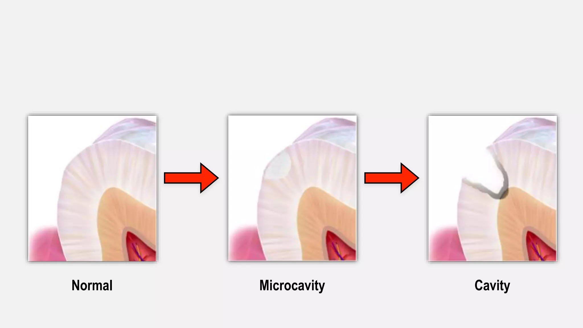 Caries Progression | PPSX