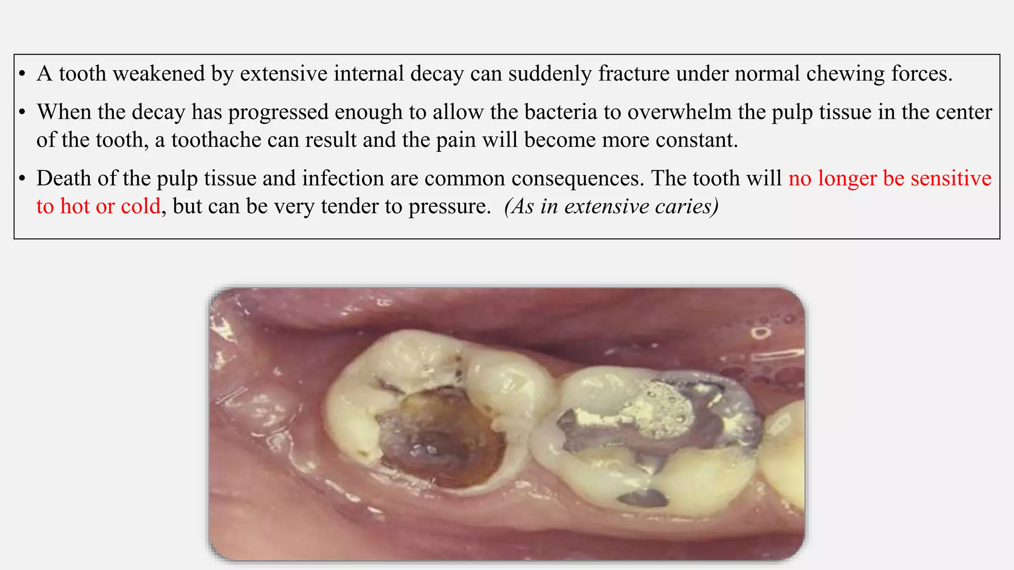 Caries Progression | PPSX