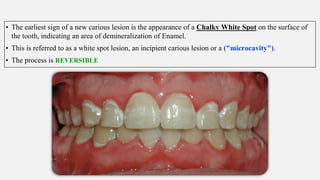 Caries Progression | PPSX