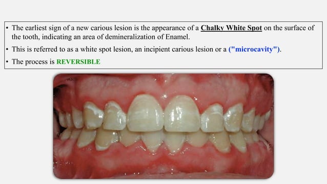 Caries Progression | PPSX | Dental Health | Diseases and Conditions