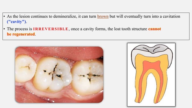 Caries Progression | PPSX | Dental Health | Diseases and Conditions