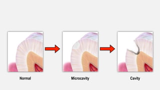 Caries Progression | PPSX