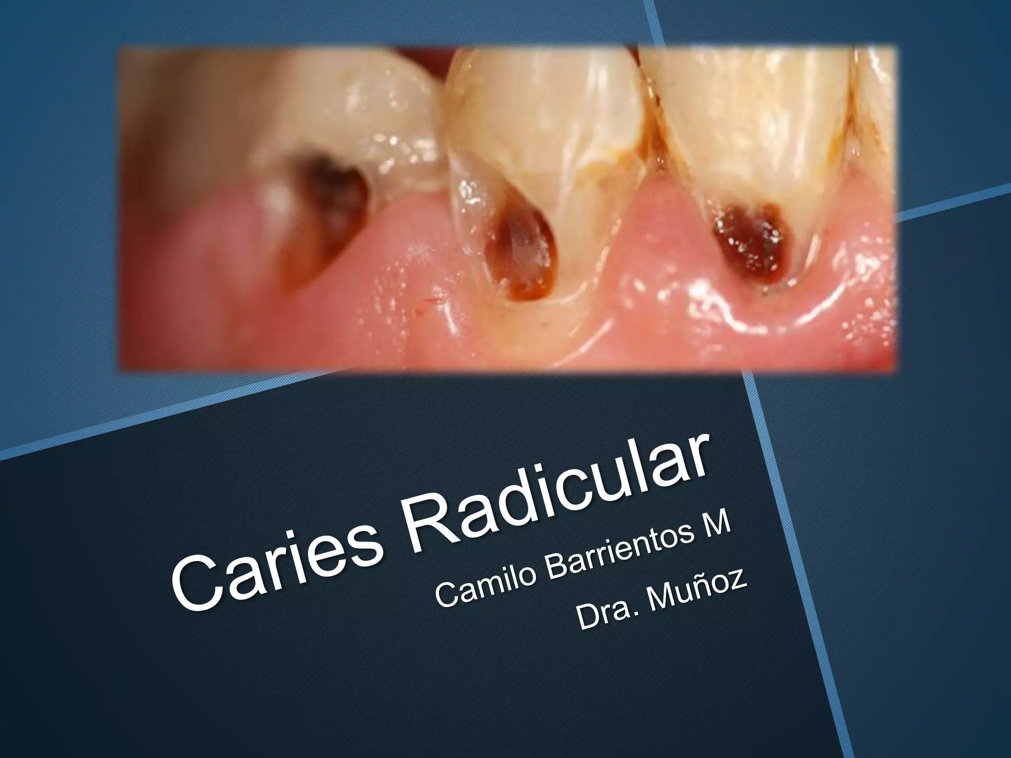 Caries radicular compl | PPTX