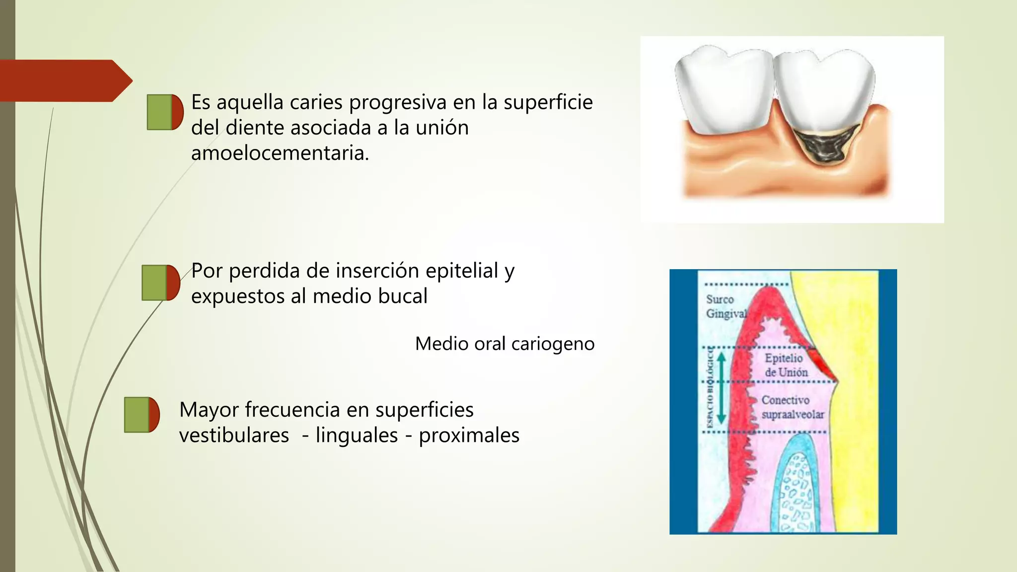 Caries radicular | PPT