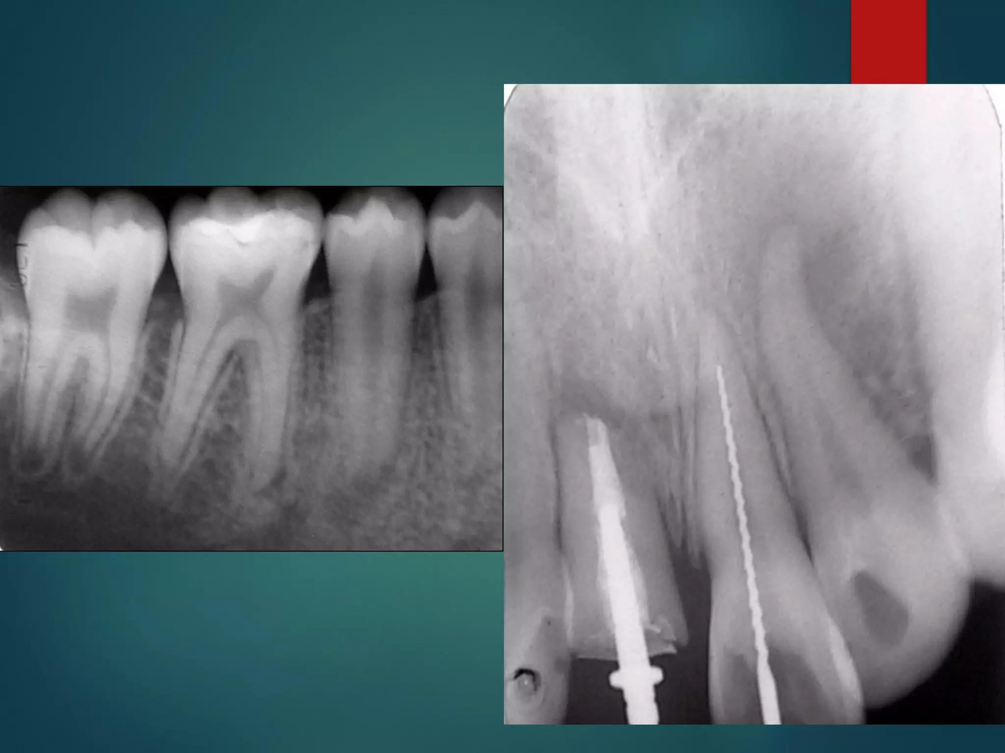 Diagnostico Radiografico de Caries | PDF