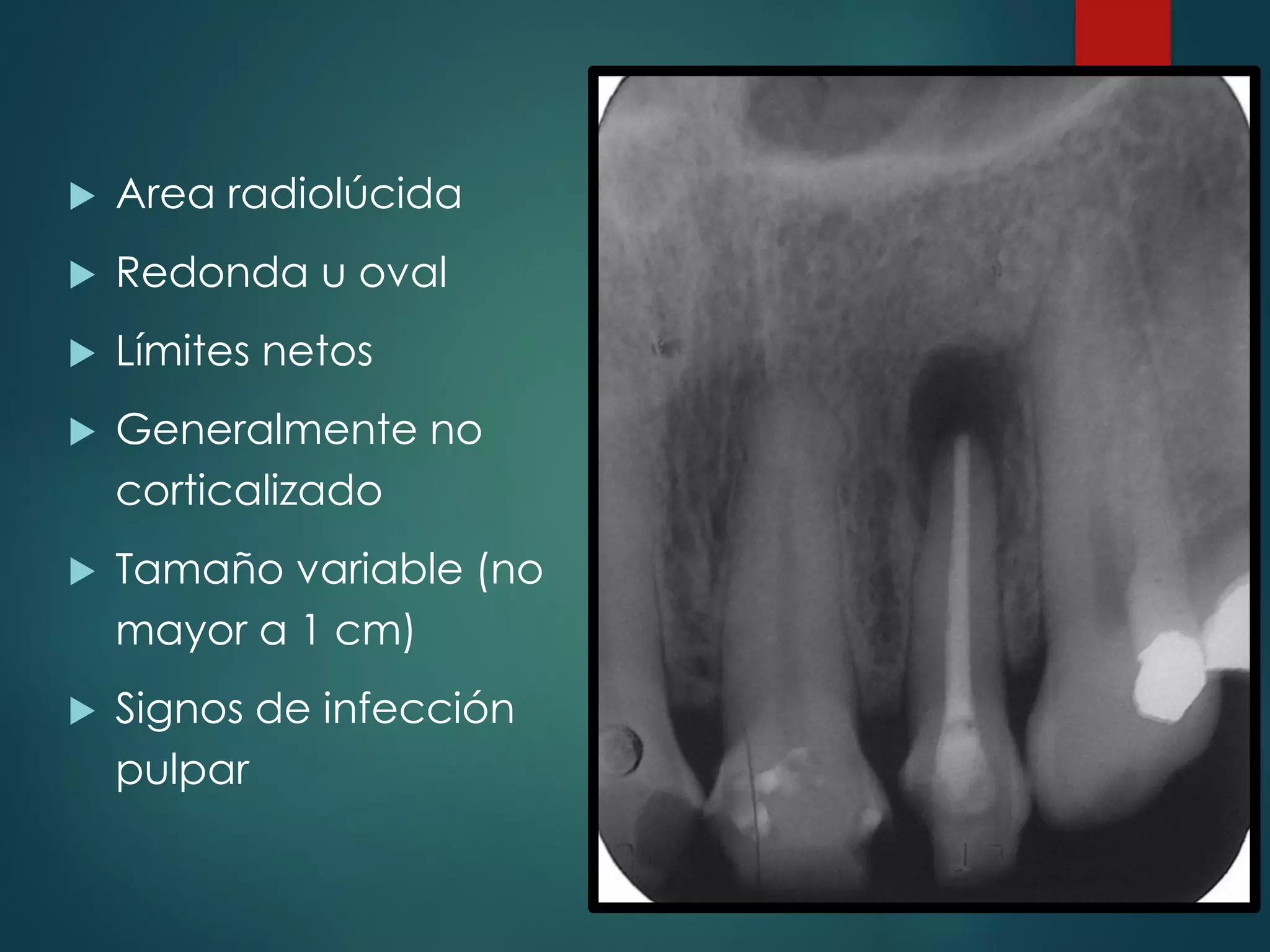 Diagnostico Radiografico de Caries | PDF