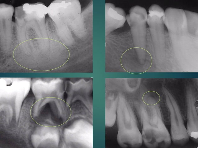 Diagnostico Radiografico de Caries | PDF